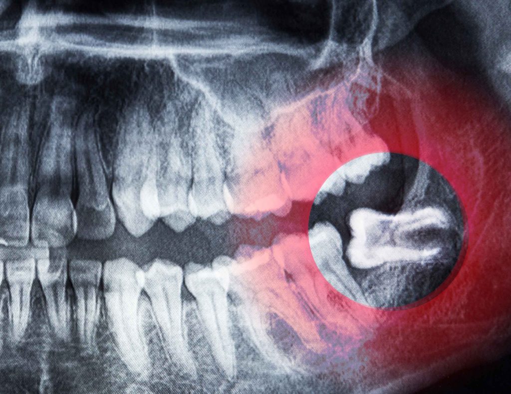Infected Wisdom Tooth Symptoms - Toronto Dental Clinic