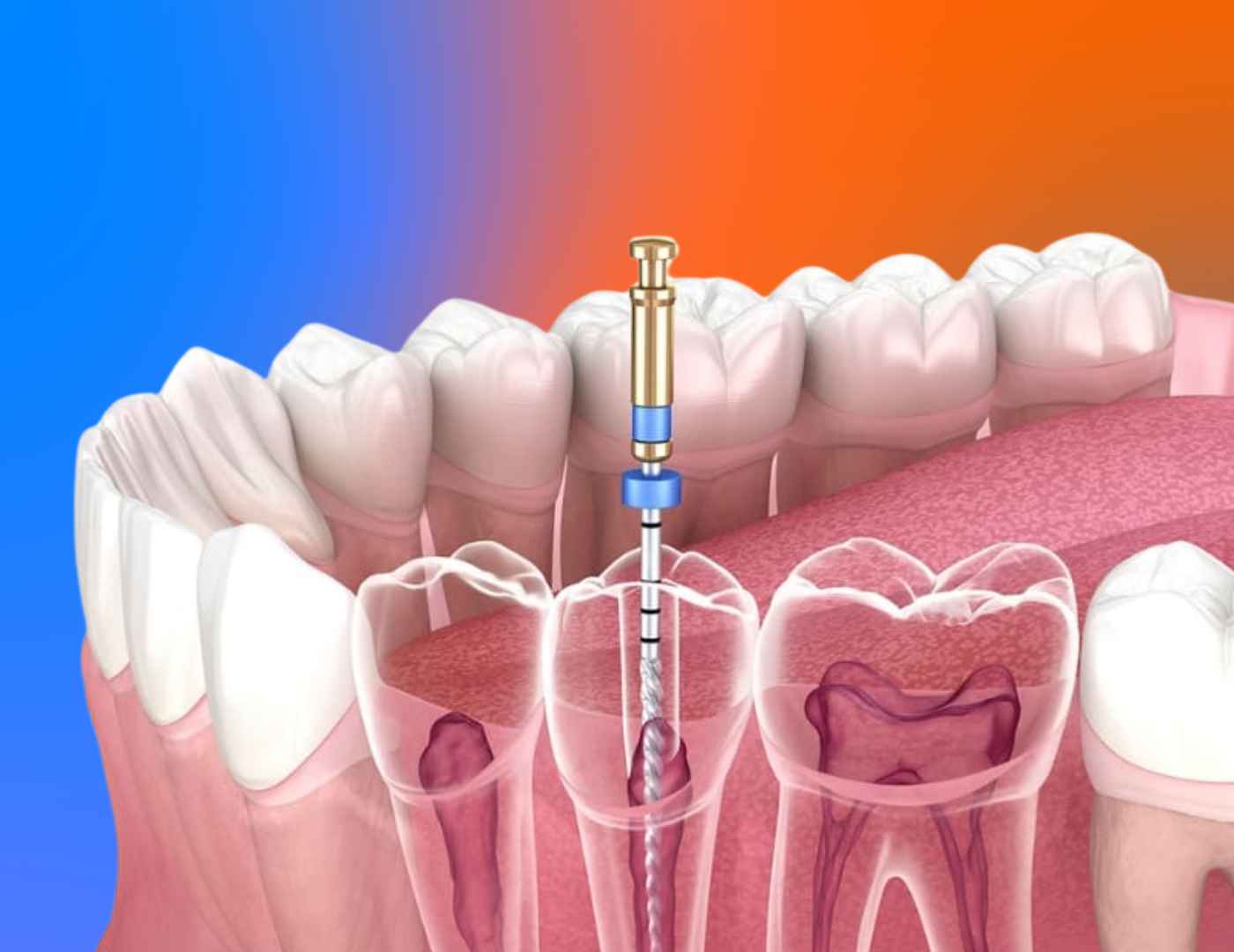 Tooth Cap vs Crown | difference between dental cap and crown - Toronto ...